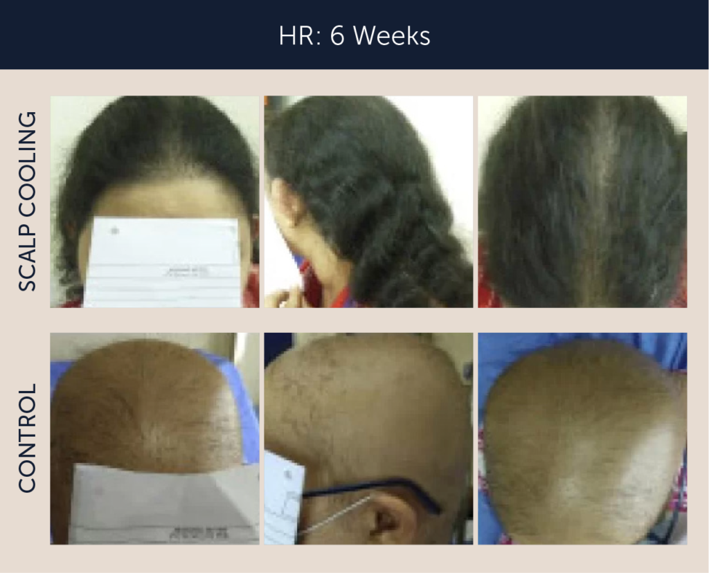 Hair regrowth with scalp cooling